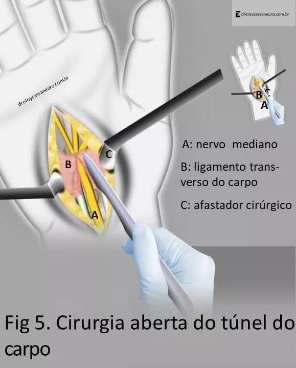 Nervo mediano: Síndrome do Túnel do Carpo - Neurologia Neuromodulação ...